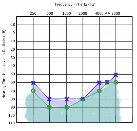 How to Read an Audiogram: The Basics